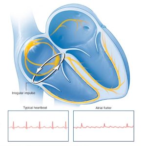 Atrial Flutter – The Heart Clinic