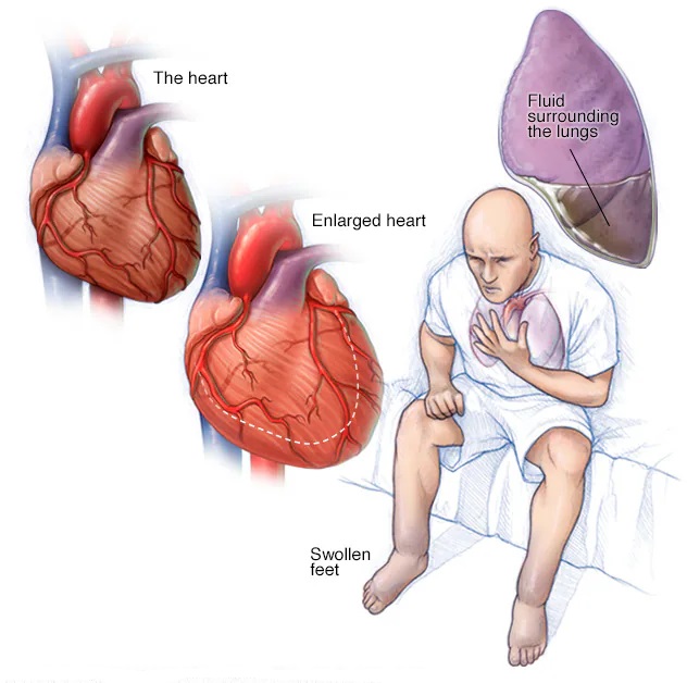 Heart Failure – The Heart Clinic