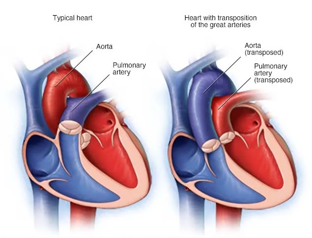 Transposition of the Great Arteries – The Heart Clinic