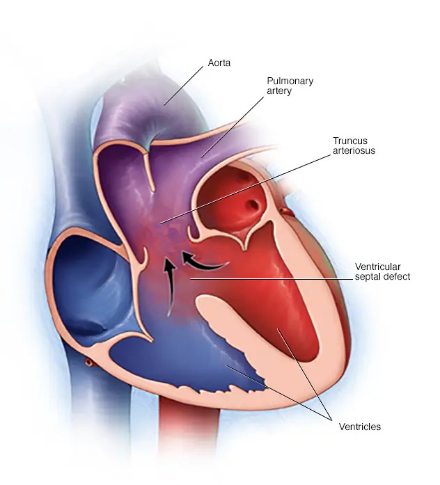 Truncus Arteriosus – The Heart Clinic